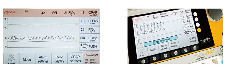 Medin-CNO无创双水平呼吸机-Q医疗·医疗信息化平台
